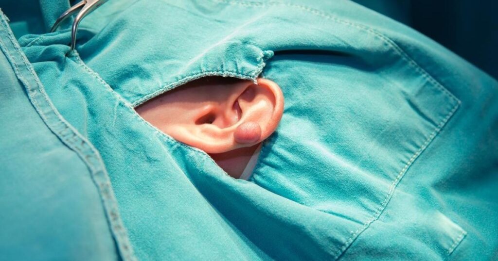 Keloid Scar Ear Surgery | Explained By Dr Shehzadi Tasneem