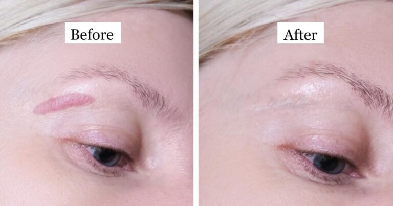 Keloid Scar Revision Surgery: Essential Insights | Best Female Plastic Surgeon In Dubai Dr ...