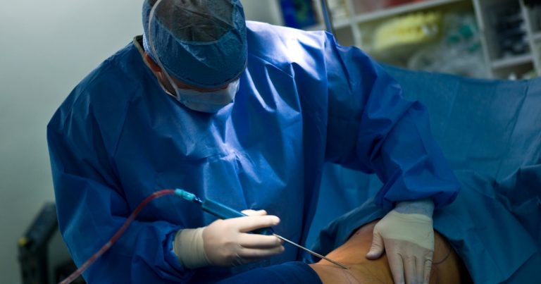 The Tummy Tuck Procedure: What You Need To Know | Best Female Plastic ...