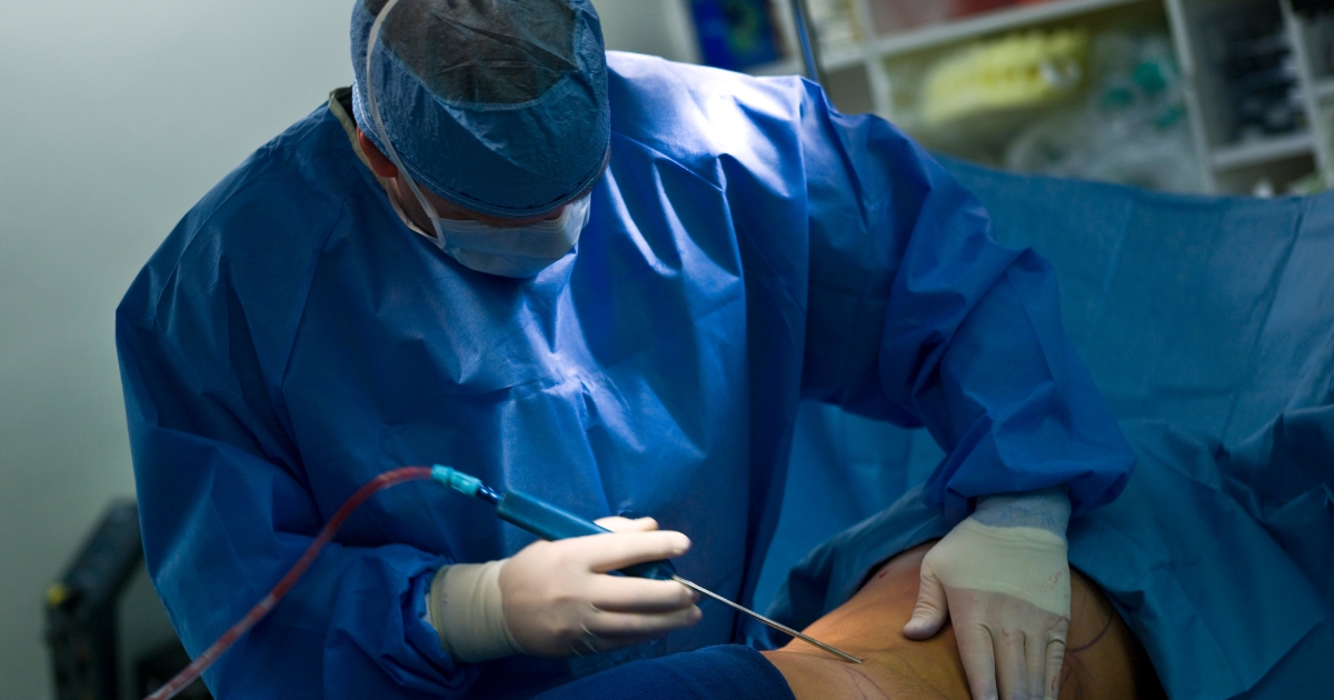 The Tummy Tuck Procedure: What You Need To Know | Best Female Plastic ...